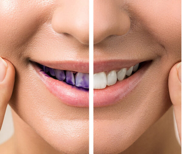 Night Out! Purple Toothpaste Stain Concealer | Smile Brilliant®