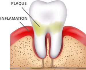 cariPRO Smooth Glide Dental Floss Picks | Smile Brilliant